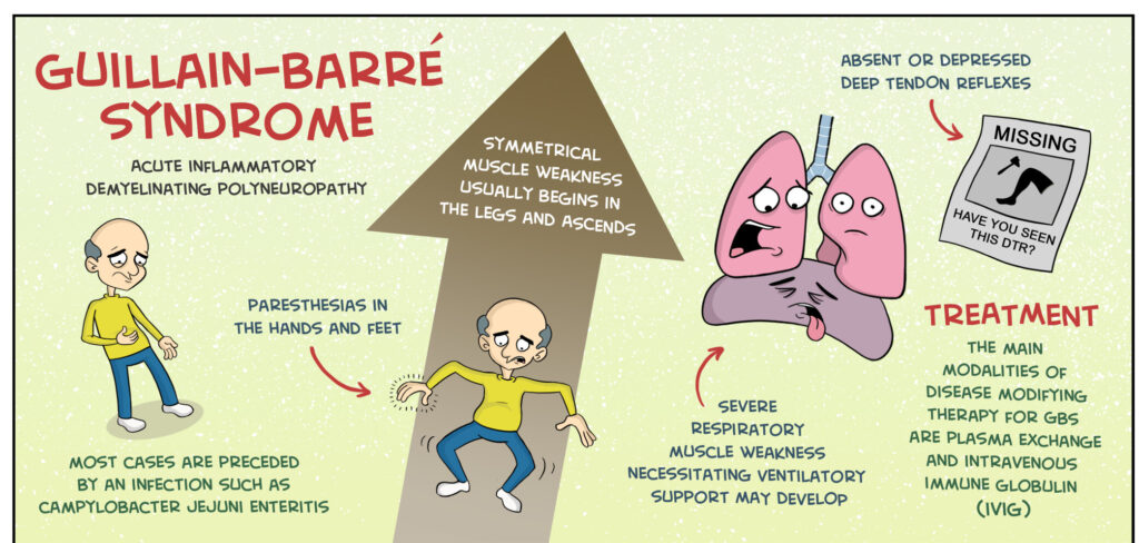 Guillain-Barré Syndrome (GBS) - FoodManifest